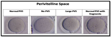 Oocyte Grading - Reviva IVF