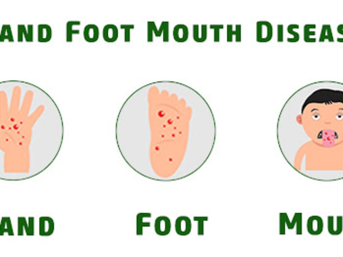 What Is Hand Foot And Mouth Disease Called In India